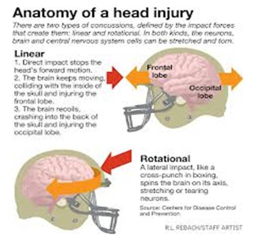 Sensing and Concussion Reduction Therapy (CRT)